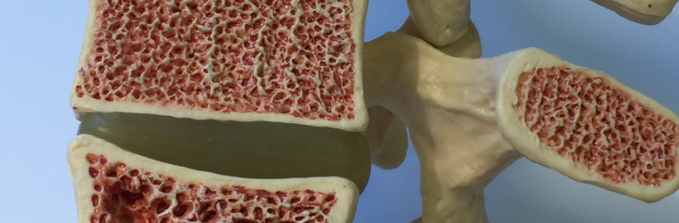 How to diagnose and help prevent osteoporosis | Article | Nexlec.com