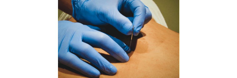 Elevate Your Clinical Skills with Level 1 Dry Needling Course by