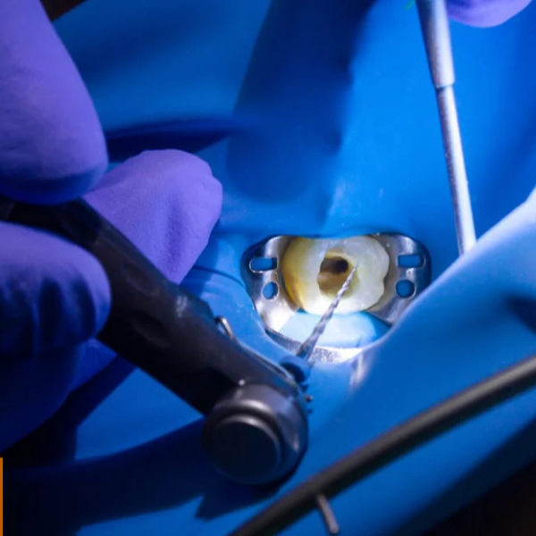 Elevate Your Practice: Unveiling the Benefits of a Rotary Endodontics