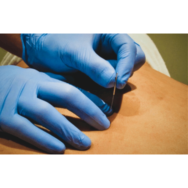 Elevate Your Clinical Skills with Level 1 Dry Needling Course by
