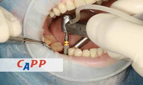 Narrow Crest Rectangular Wedge Piezoimplant and the Traditional