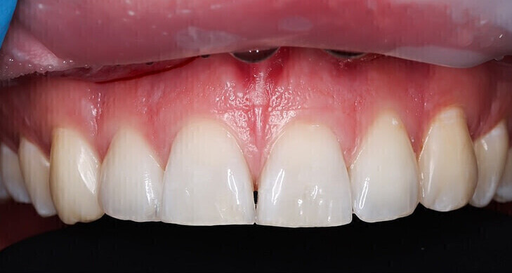 Mastering exocad Course | Dentistry Course | Nexlec.com