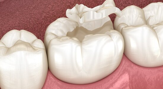 Porcelain Inlays, Onlays, Overlays & Vonlays Tooth Preparation
