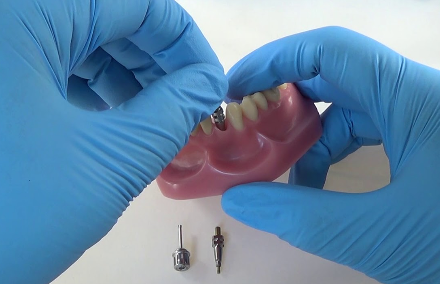 Hands-on Implant Restorative Course | Dentistry Course | Nexlec.com